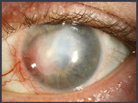 Viral Keratitis Darshan Eye Care