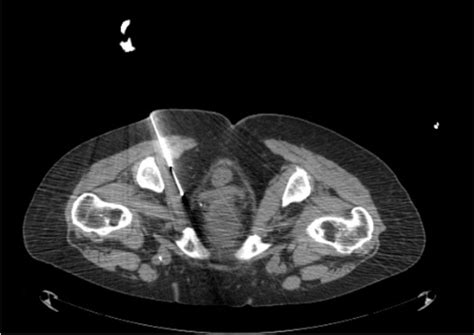 Pudendal Nerve Block Ablation — Radcall Procedure Guide
