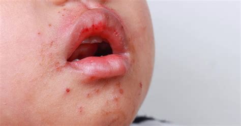 Doh Hand Food Mouth Disease Cases Up 7 Times This Year Vs 2024