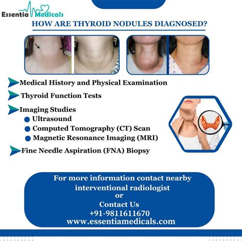 Essentia Medicals Thyroid Nodules A Common Concern Thyroid Nodules