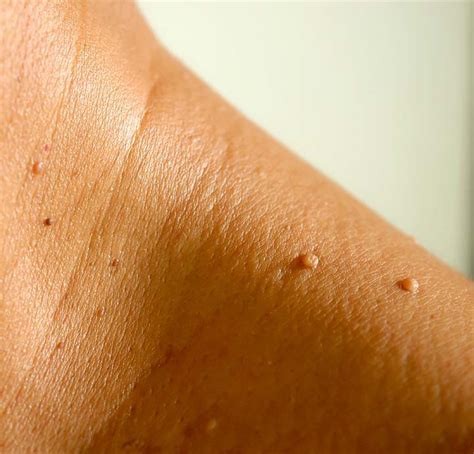Symptoms And Conditions Skin Tags Drscholls