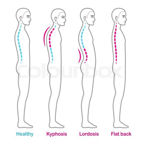 Back Posture Problems Medical Diagram Young Man With Kyphos Colourbox