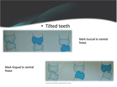 Occlusal Equilibration Orthodontic Seminars Pptx