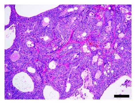 Histopathological Appearance Of The Buccal Mass The Mass Is Composed Download Scientific