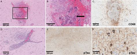 Chronic Herpes Simplex Virus Encephalitis With Unexpected