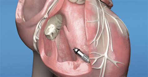 Medtronics Next Generation Leadless Pacemakers Gain Fda Approval