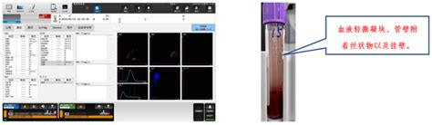 被 谁”干扰的血小板计数？学术交流检验视界检验视界网