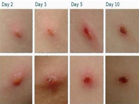 Understanding The Stages Of Chickenpox Symptoms Progression And Recovery Sehat Tak Health News