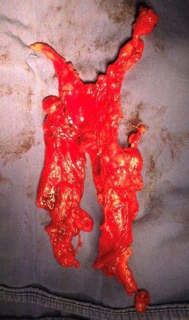 Dr Fazil Mohamed Azeem Ms General Surgery Frcs Glass Frcs Cth