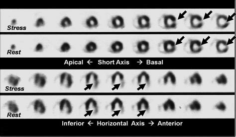 Exercise Myocardial Nuclear Perfusion Scan Shows Basal Lateral Fixed