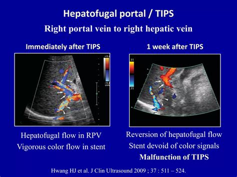Doppler Ultrasound Of The Portal System Pathological Findings