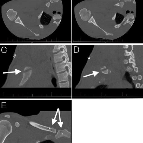 Ct Scan Showing Right Posterior Sc Joint Dislocation With The Medial