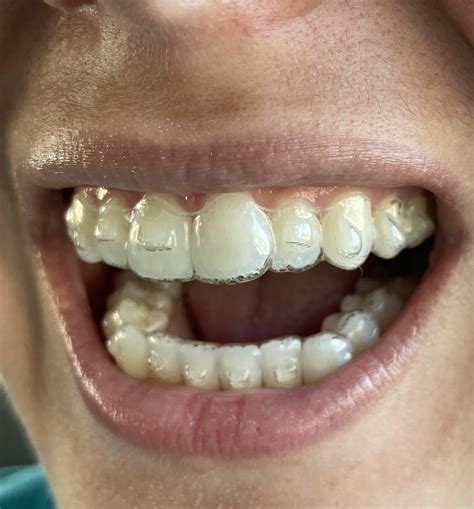 Tracking Issues R Invisalign