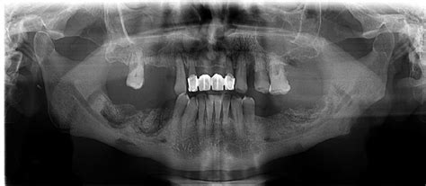 Bilateral Mandibular Sequestrum Premolar Avulsion Download