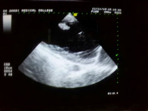 Neelz On Wheelz A Case Of Dcmp With Lv Apical Aneurysm With Aneurysmal