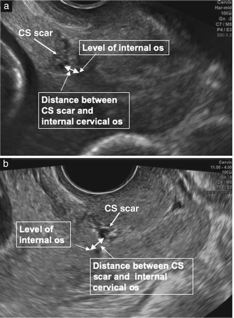 Cervical Os