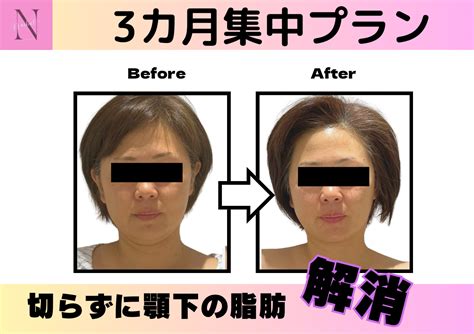 切らない脂肪吸引術★ 成城センター南 小顔専門店 Nachul