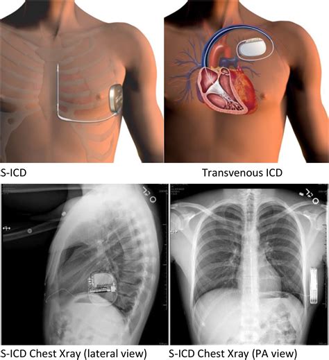 Implantable Cardioverter Defibrillator Vs Pacemaker