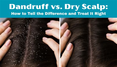 Difference Between Eggs And Dandruff