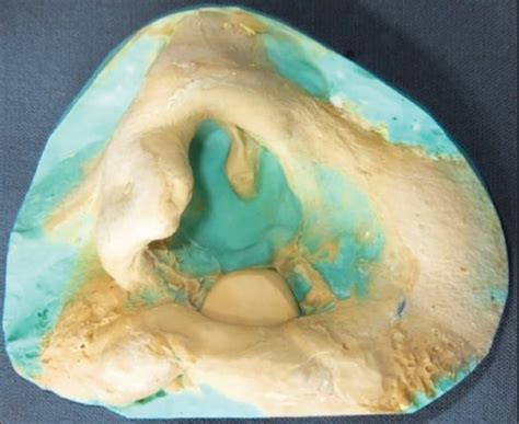 Nasal Prosthesis With Magnetically Secured Intranasal Framework For A Patient With Partial