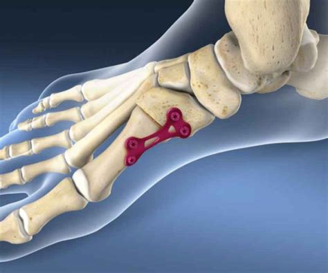 Tarsometatarsal Joint Arthrodesis