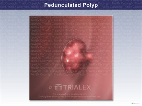 Pedunculated Polyp