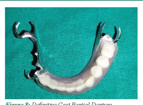Figure 8 From Marginal Mandibulectomy Defect Rehabilitated With Cast Partial Denture A Case
