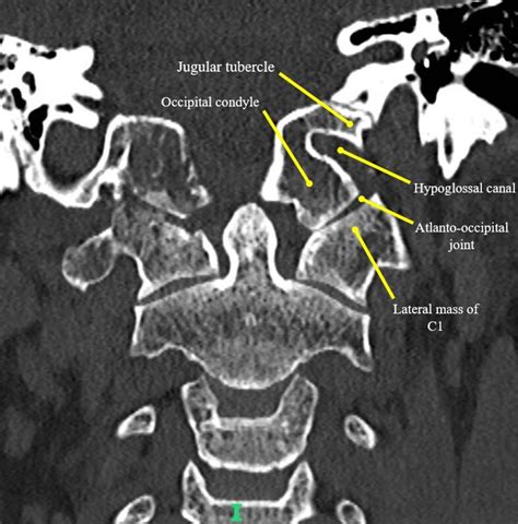 Occipital Condyle Syndrome A Rare Manifestation Of Skull Base