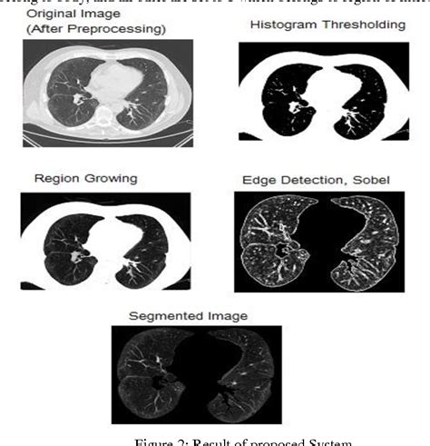 figure 2 from lung segmentation using region growing algorithm