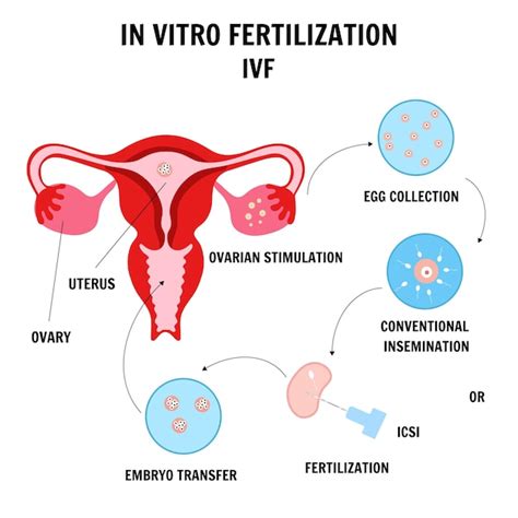 Concept De Fécondation In Vitro Avec Procédure De Préparation Du Sperme