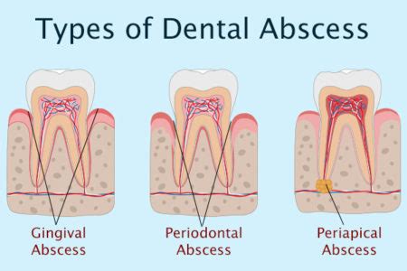 Tooth Abscess Causes And How Long Does It Take To Heal