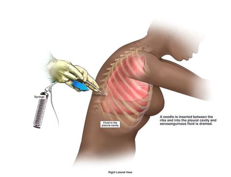 Thoracentesis Procedure