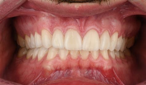 Full And Partial Laminate Veneers Aesthetic Smile Restoration