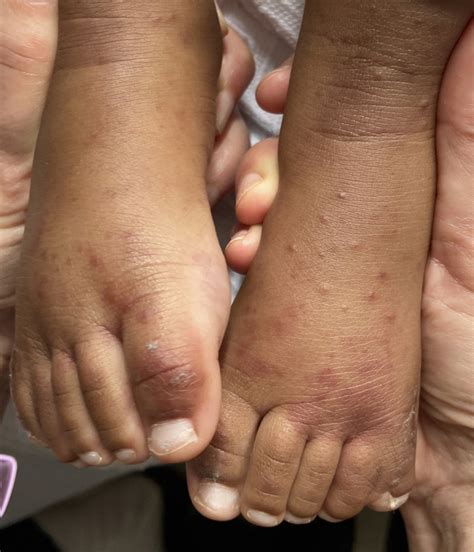 Post‐streptococcal Small‐vessel Vasculitis In A 16‐month‐old With