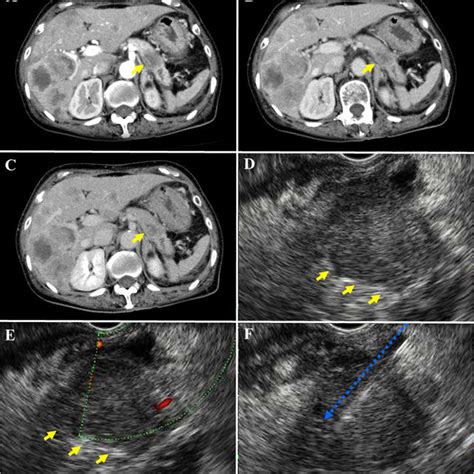 Findings Of Dynamic Computed Tomography And Endoscopic Ultrasound