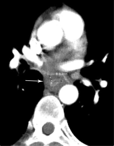 Esophageal Pseudodiverticula Pacs