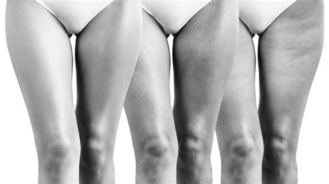The Cellulite Myth How The Invented Disease Took Hold And Shattered