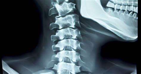 Soft Tissue Neck X Ray Insights Urban Health Hive]