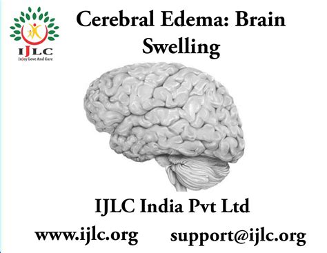 Ijlc India Private Limited Cerebral Edema Brain Swelling Cerebral