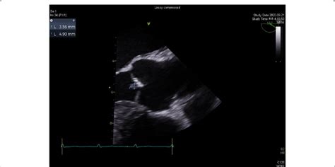 Transesophageal Echocardiography Image Shows Aortic Valve Vegetation