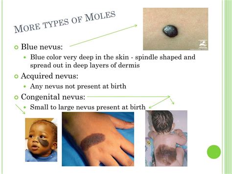 Types Of Moles In Virginia At Oneida Roberson Blog
