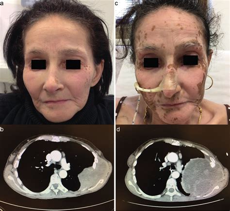 Vitiligo Re Pigmentation Associated With Melanoma Progression During