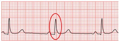 Transcutaneous Pacing Review Nursing Ce Central