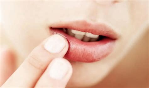 Stomatitis Prevention Types Causes Symptoms Treatment And Recommendations Of Dentists