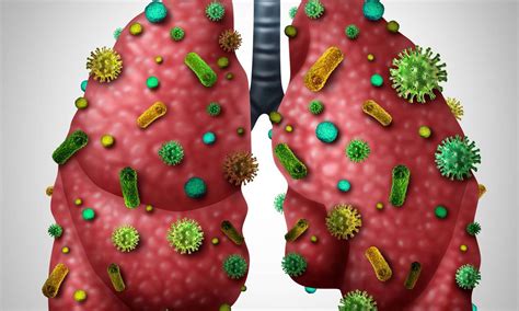 Fda Approves Xacduro For Pneumonia Caused By Acinetobacter
