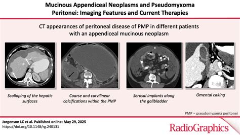 Mucinous Appendiceal Neoplasms And Pseudomyxoma Peritonei Imaging