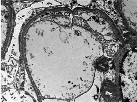 Case 2 Electron Microscopy Glomerulus Image Download Scientific