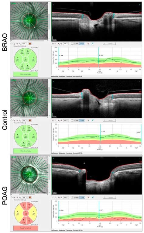 Gabriella De Salvo On Linkedin Inner Retinal Thinning Comparison