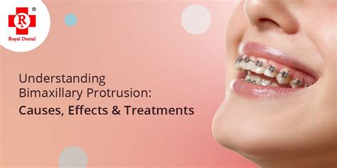 Bimaxillary Protrusion Impact On Facial Aesthetics And Treatment Options