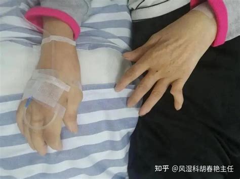 类风湿治疗的两大法宝，今天全部告诉你！ 知乎